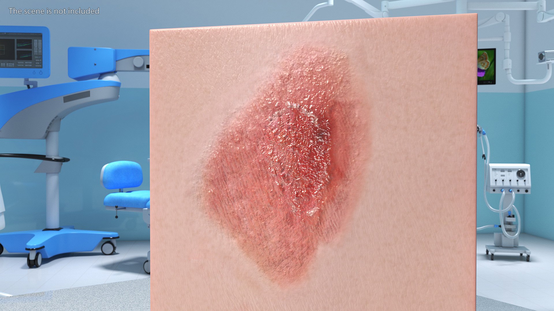 3D Burned Skin Model - TurboSquid 2159253