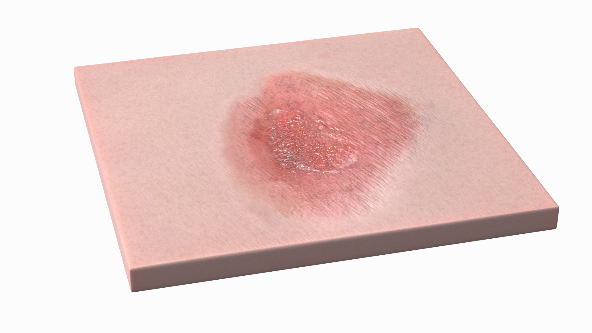 3D Burned Skin Model - TurboSquid 2159253