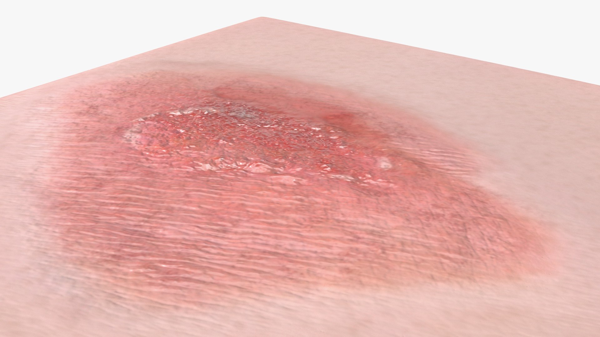 3D Burned Skin Model - TurboSquid 2159253