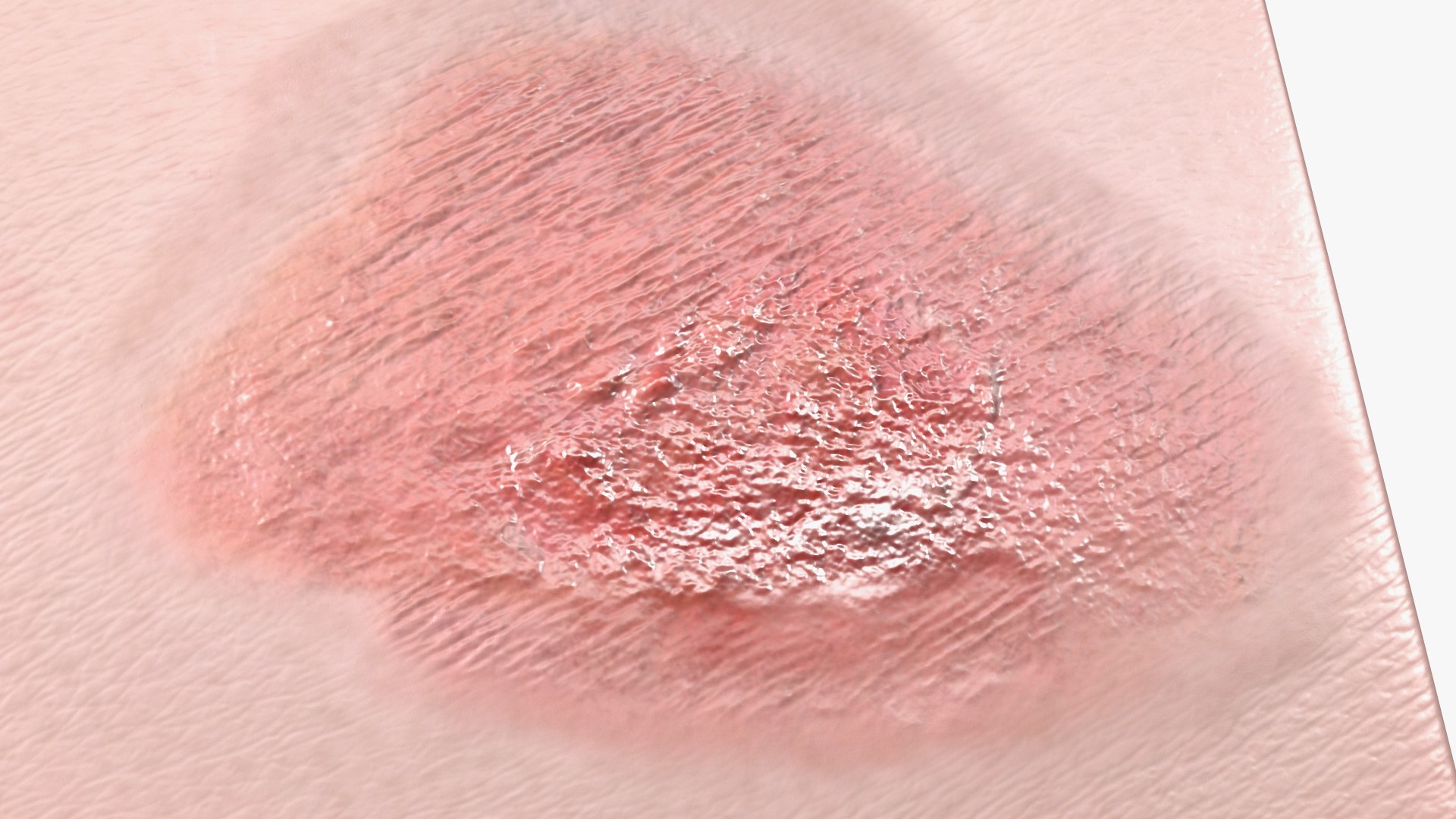 3D Burned Skin Model - TurboSquid 2159253