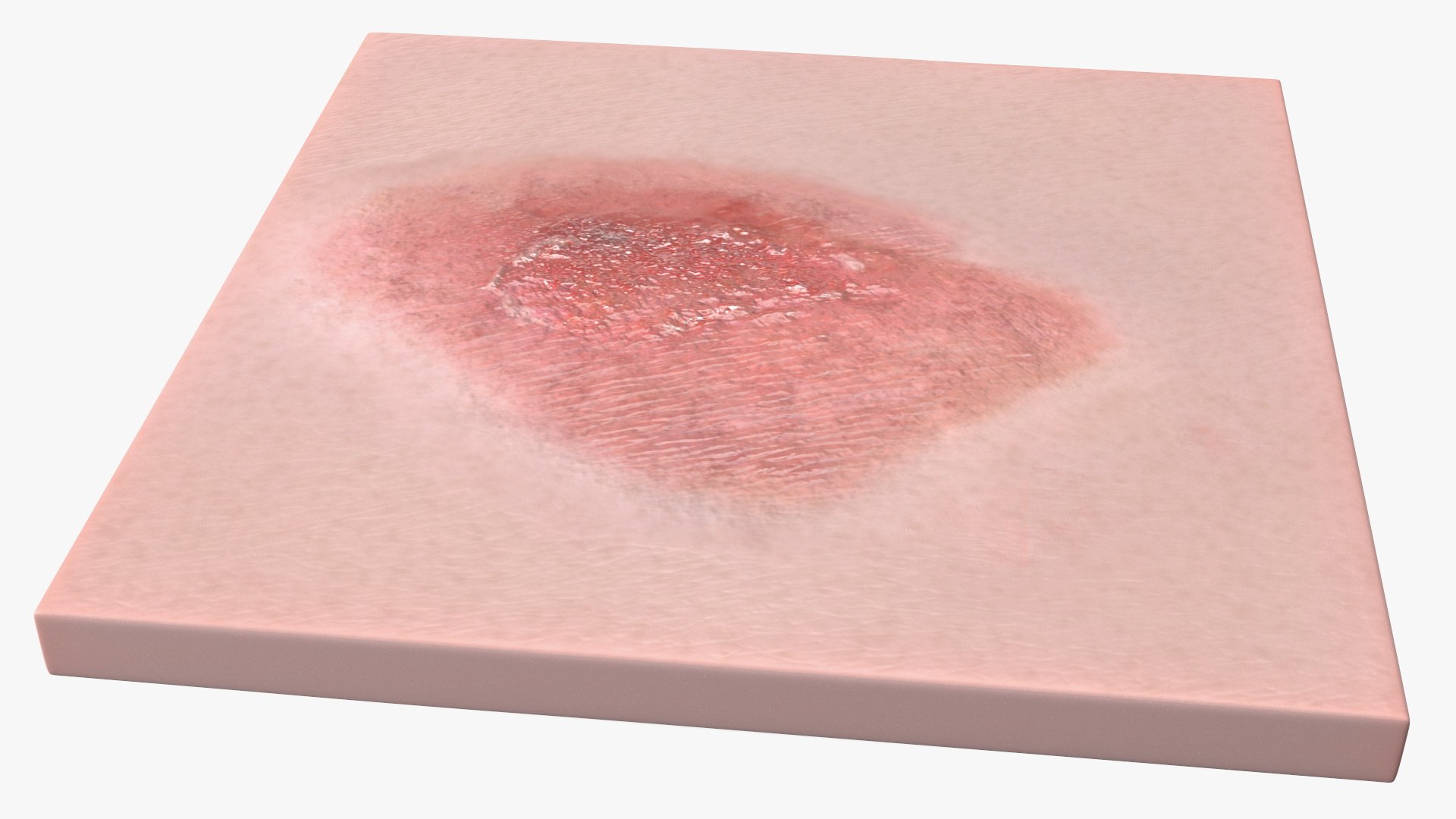 3D Burned Skin Model - TurboSquid 2159253