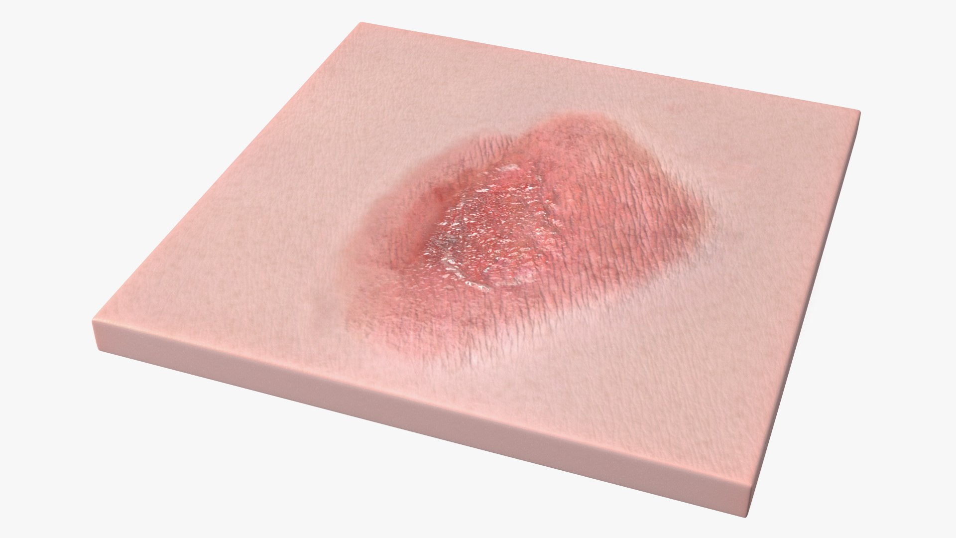 3D Burned Skin Model - TurboSquid 2159253