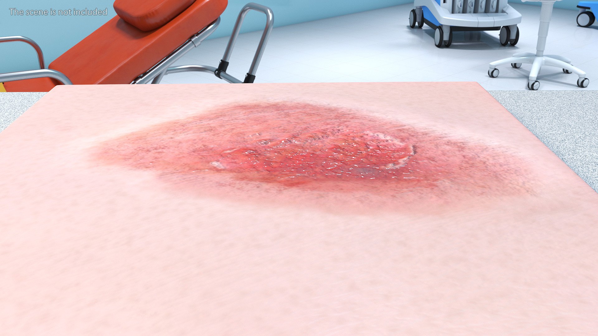 3D Burned Skin Model - TurboSquid 2159253