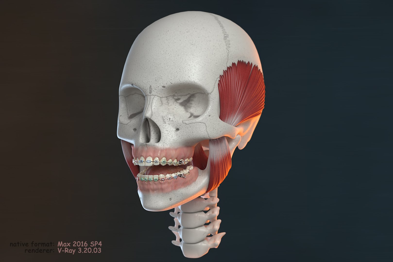Ortho Skull V-ray Orthodontics Model - TurboSquid 1339457
