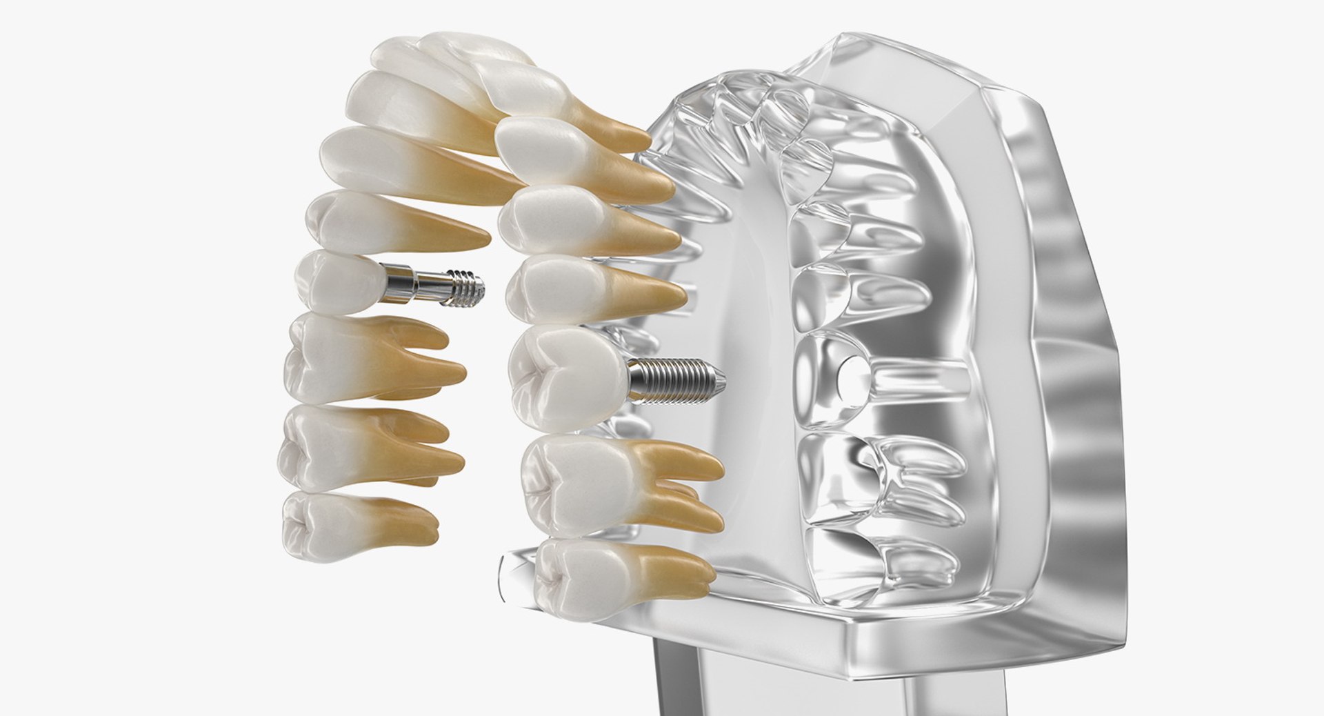 3D transparent dental typodont implants - TurboSquid 1428983