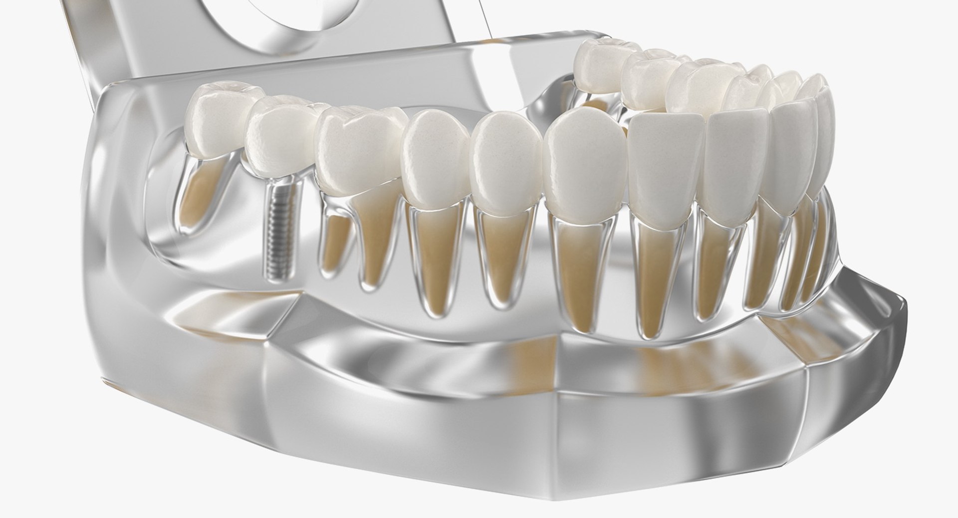 3D Transparent Dental Typodont Implants - TurboSquid 1428983