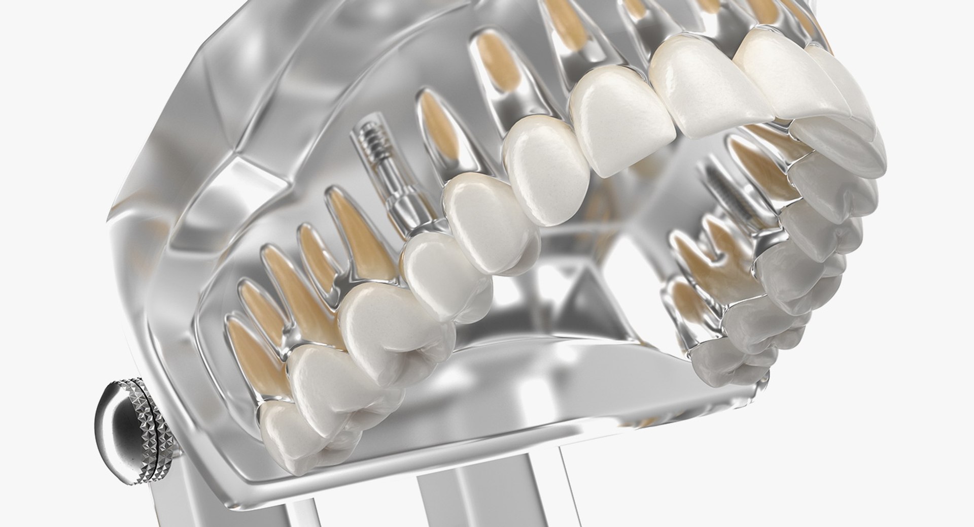 3D Transparent Dental Typodont Implants - TurboSquid 1428983