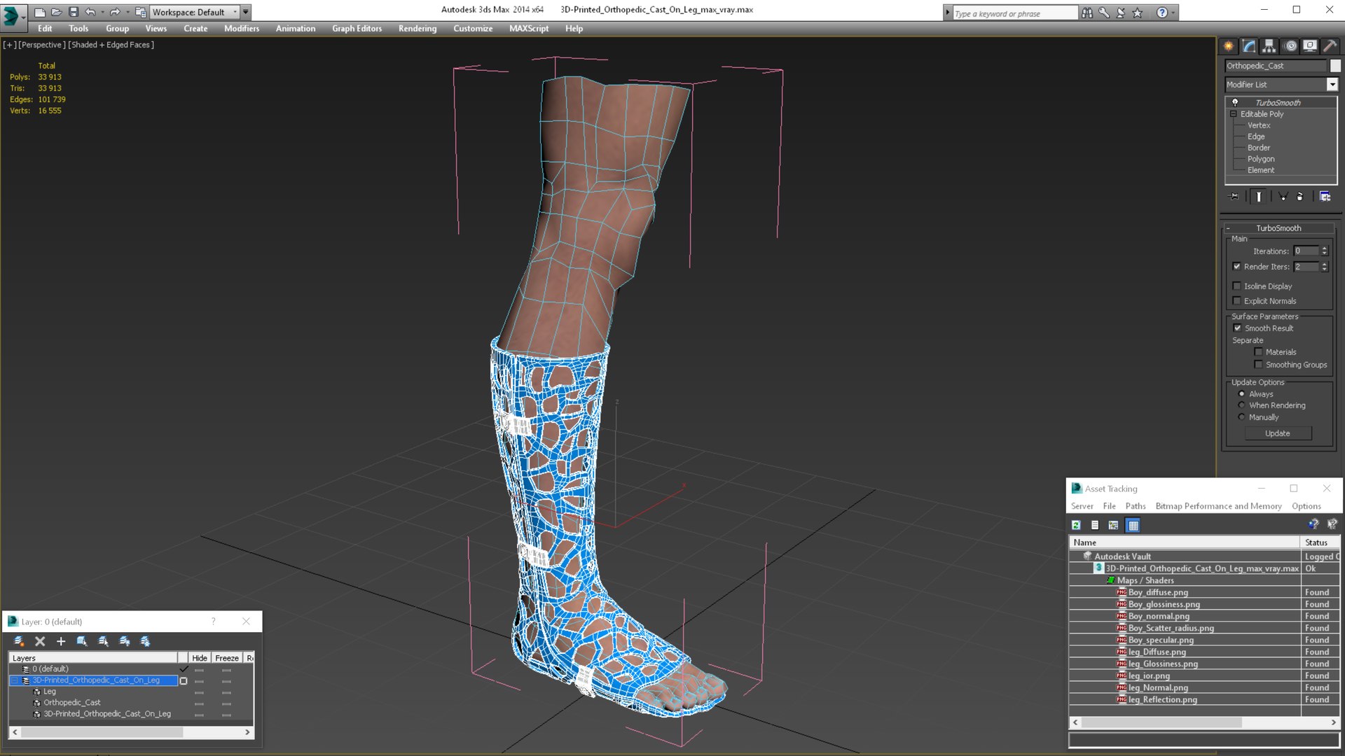 3D-Printed Orthopedic Cast On Leg Model - TurboSquid 1900350