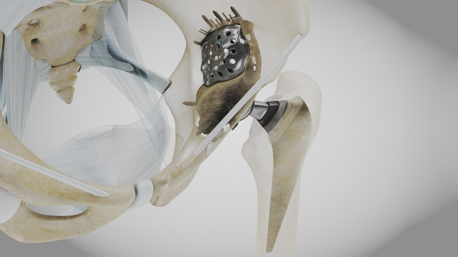 Replaced Pelvic Implant 3D model - TurboSquid 2133470