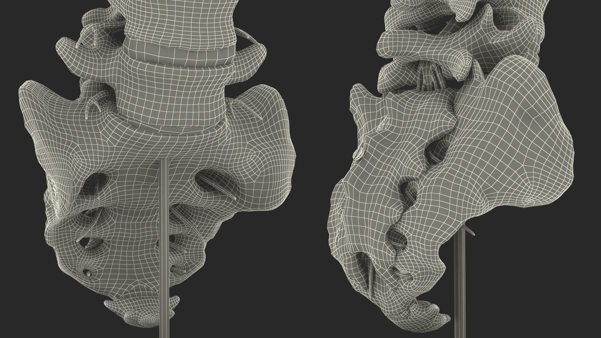 Spinal Column with Hernia on Stand 3D - TurboSquid 2051092
