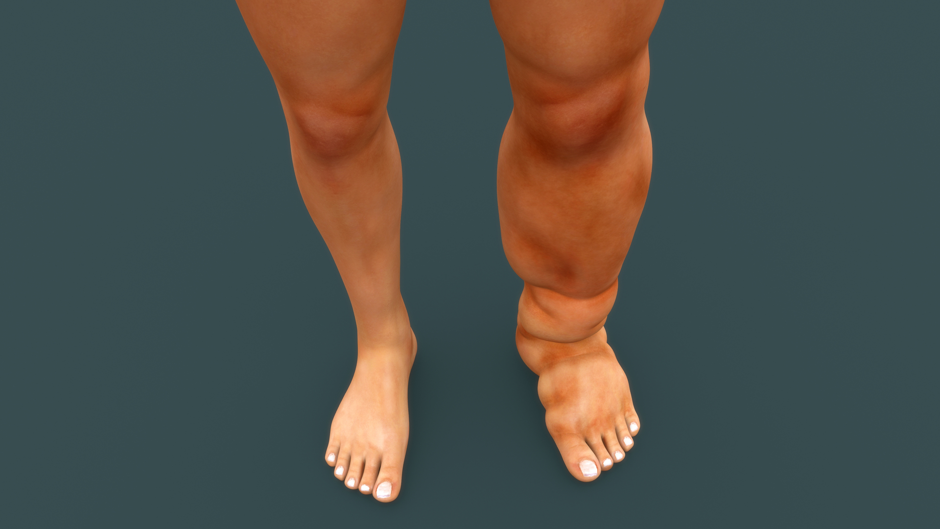 modèle 3D de Filariose lymphatique - TurboSquid 1791181