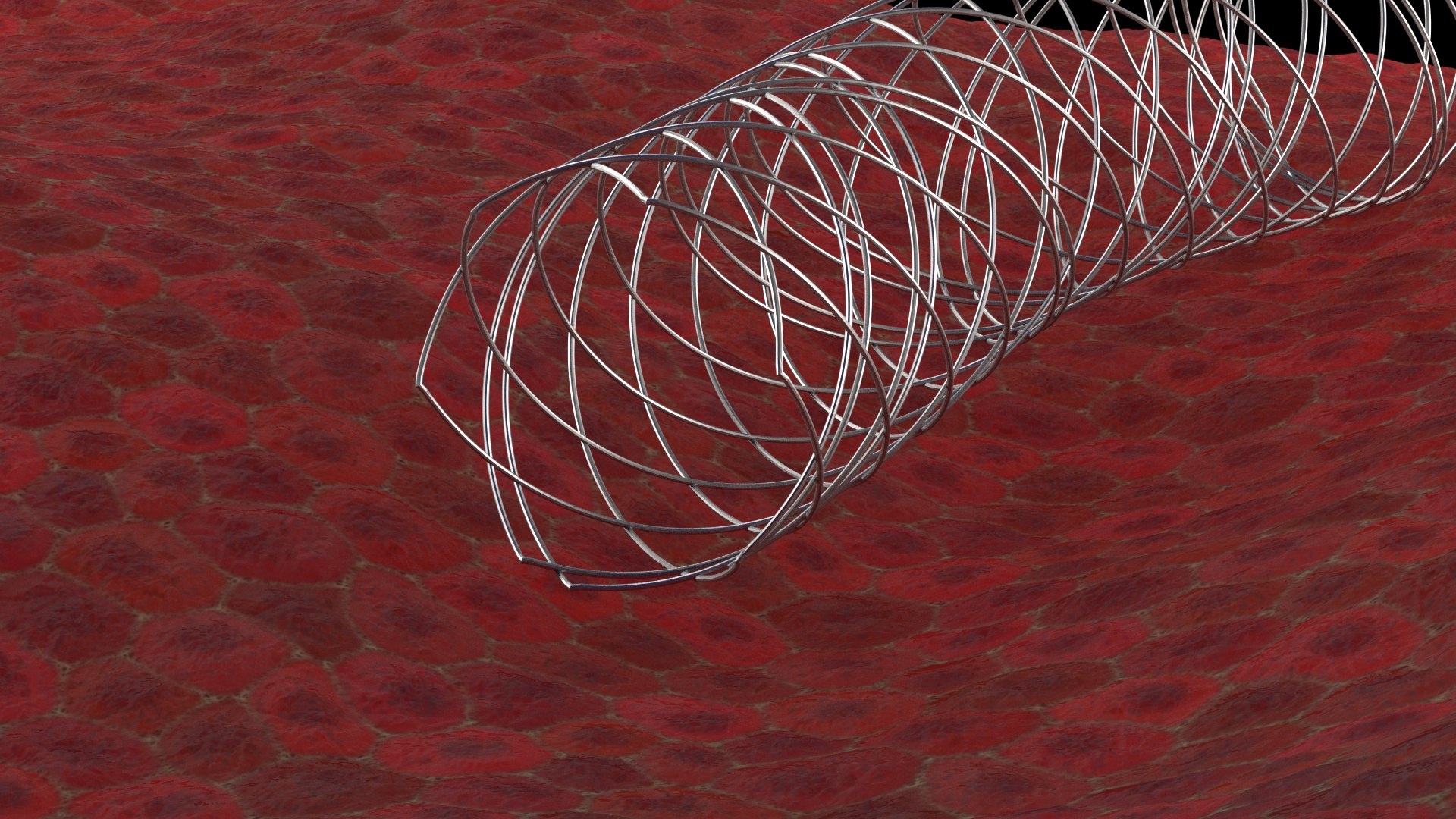 3D Model Stent Medicine Science - TurboSquid 1681496