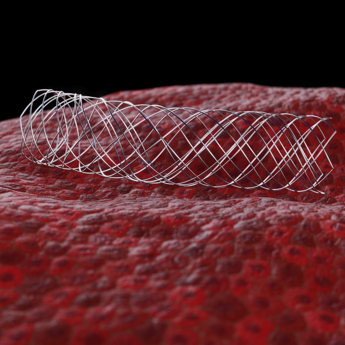 3D model stent medicine science - TurboSquid 1681496