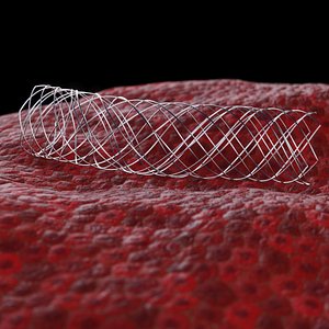 Stent 3D Models for Download | TurboSquid