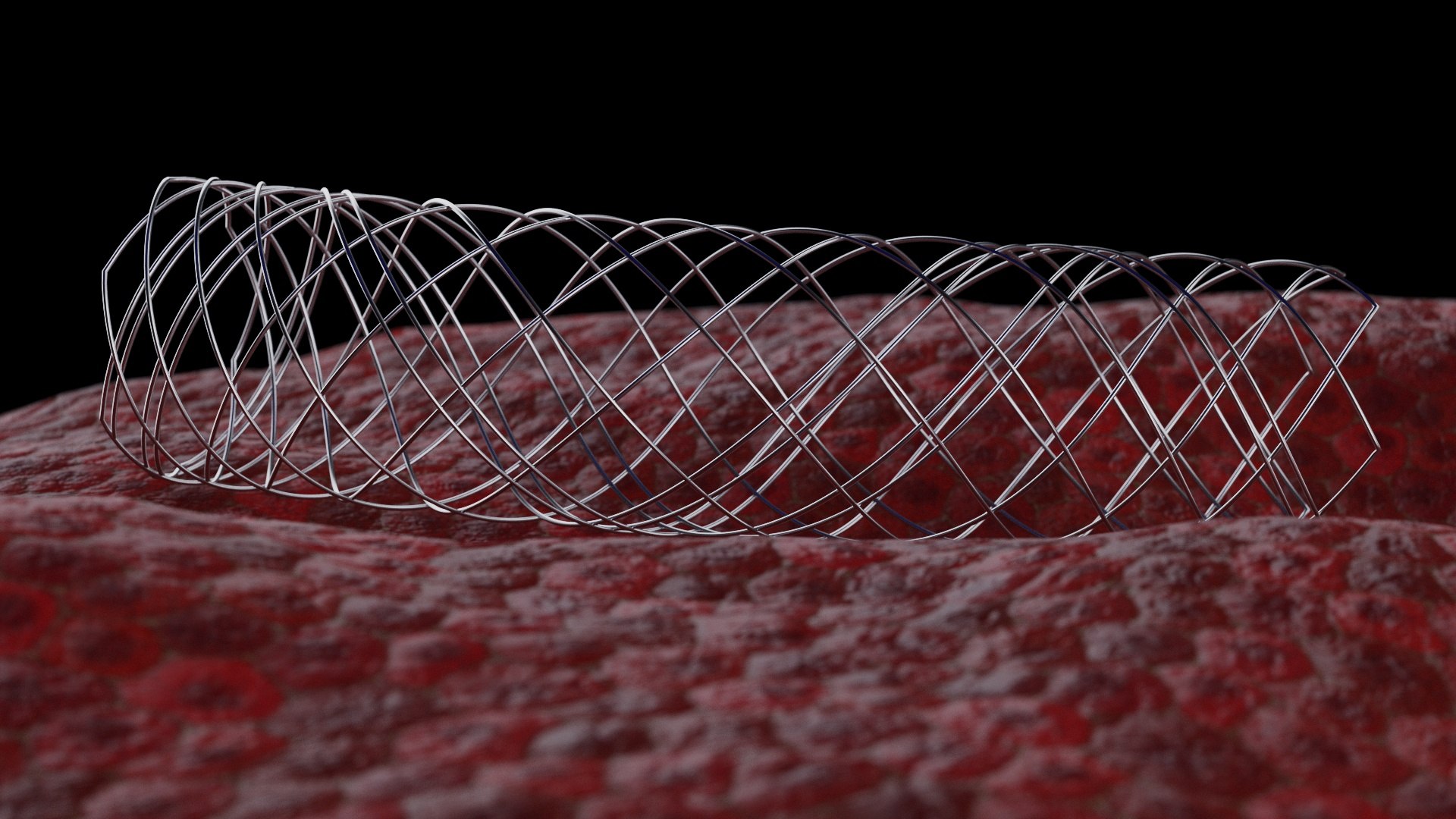 3D Model Stent Medicine Science - TurboSquid 1681496