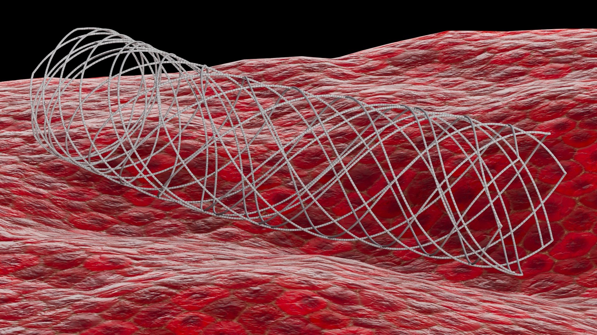 3D Model Stent Medicine Science - TurboSquid 1681496