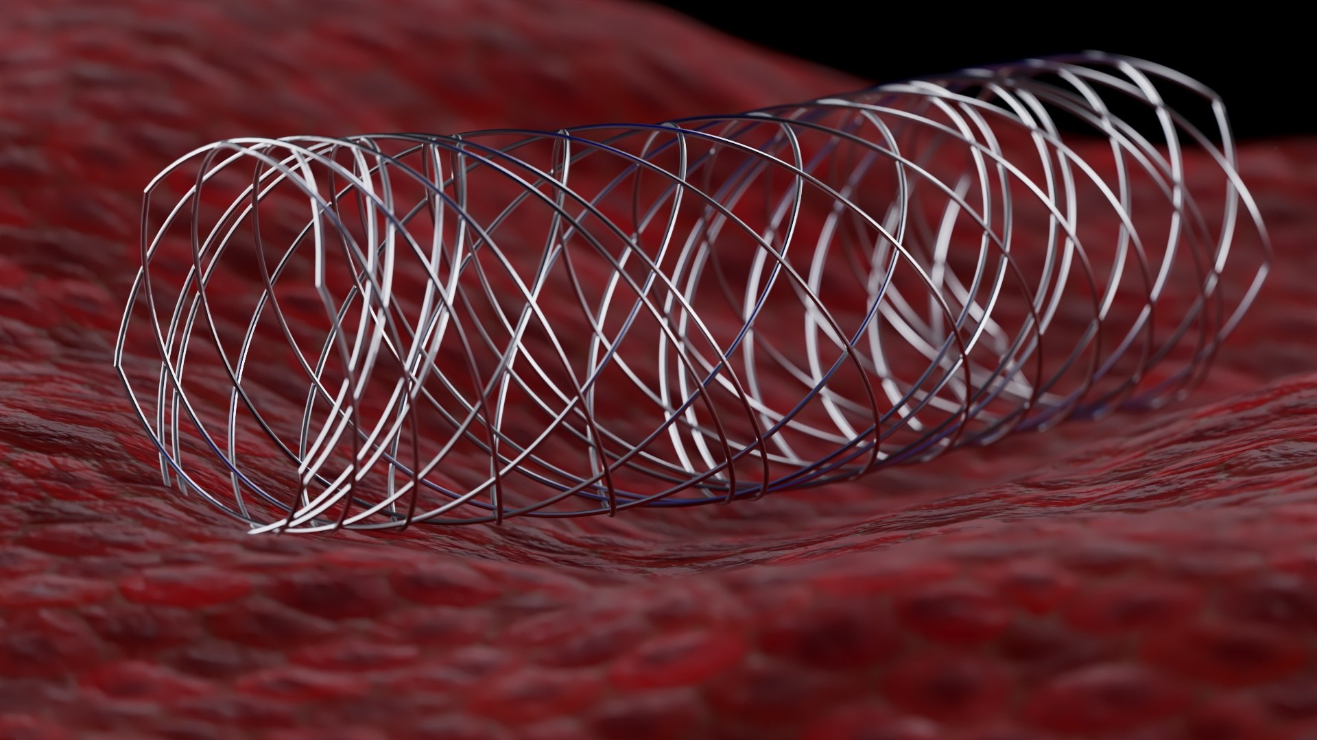 3D Model Stent Medicine Science - TurboSquid 1681496