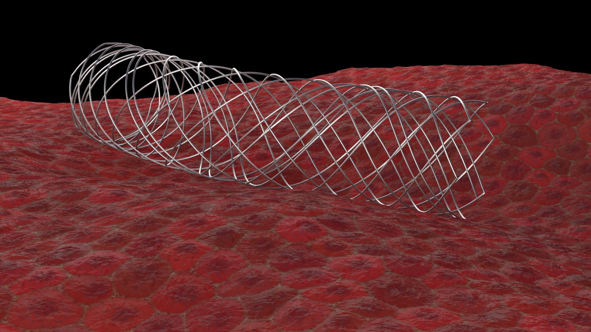 3D Model Stent Medicine Science - TurboSquid 1681496