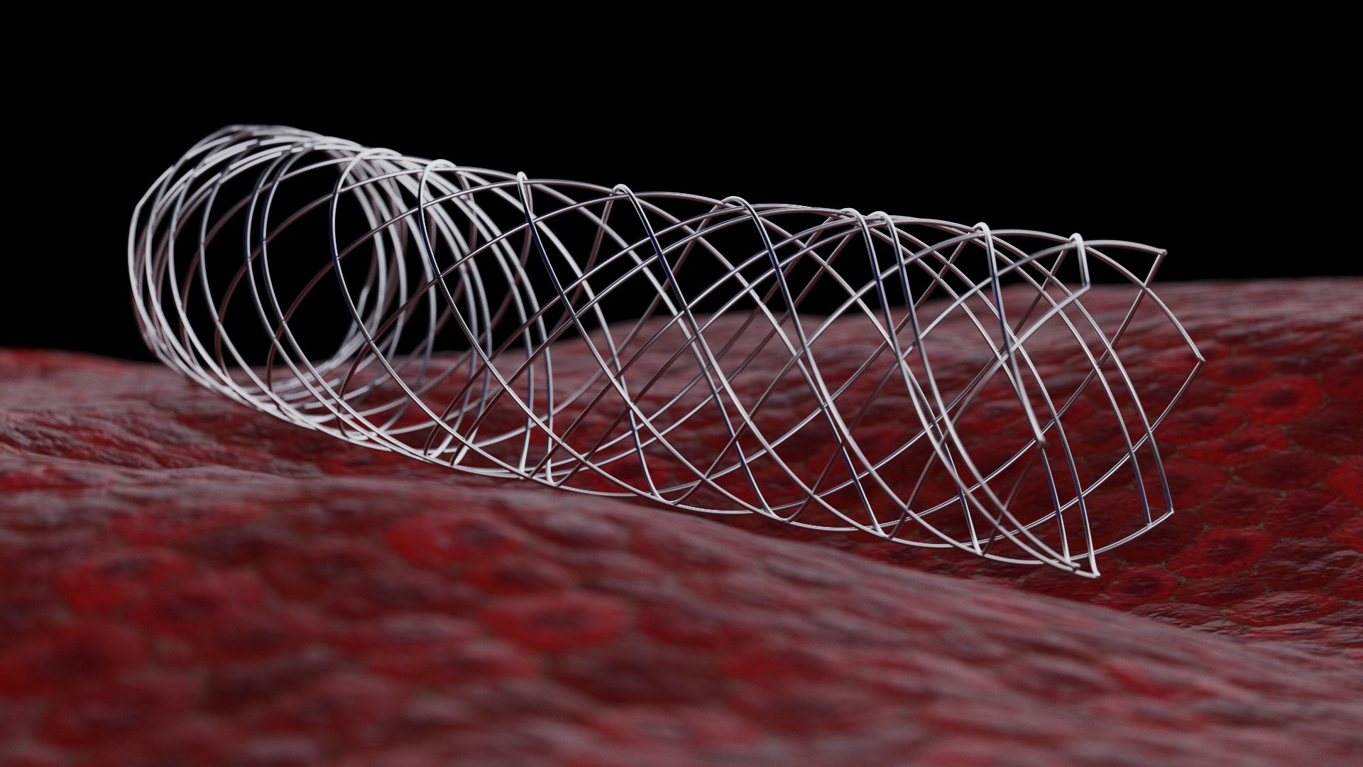 3D Model Stent Medicine Science - TurboSquid 1681496