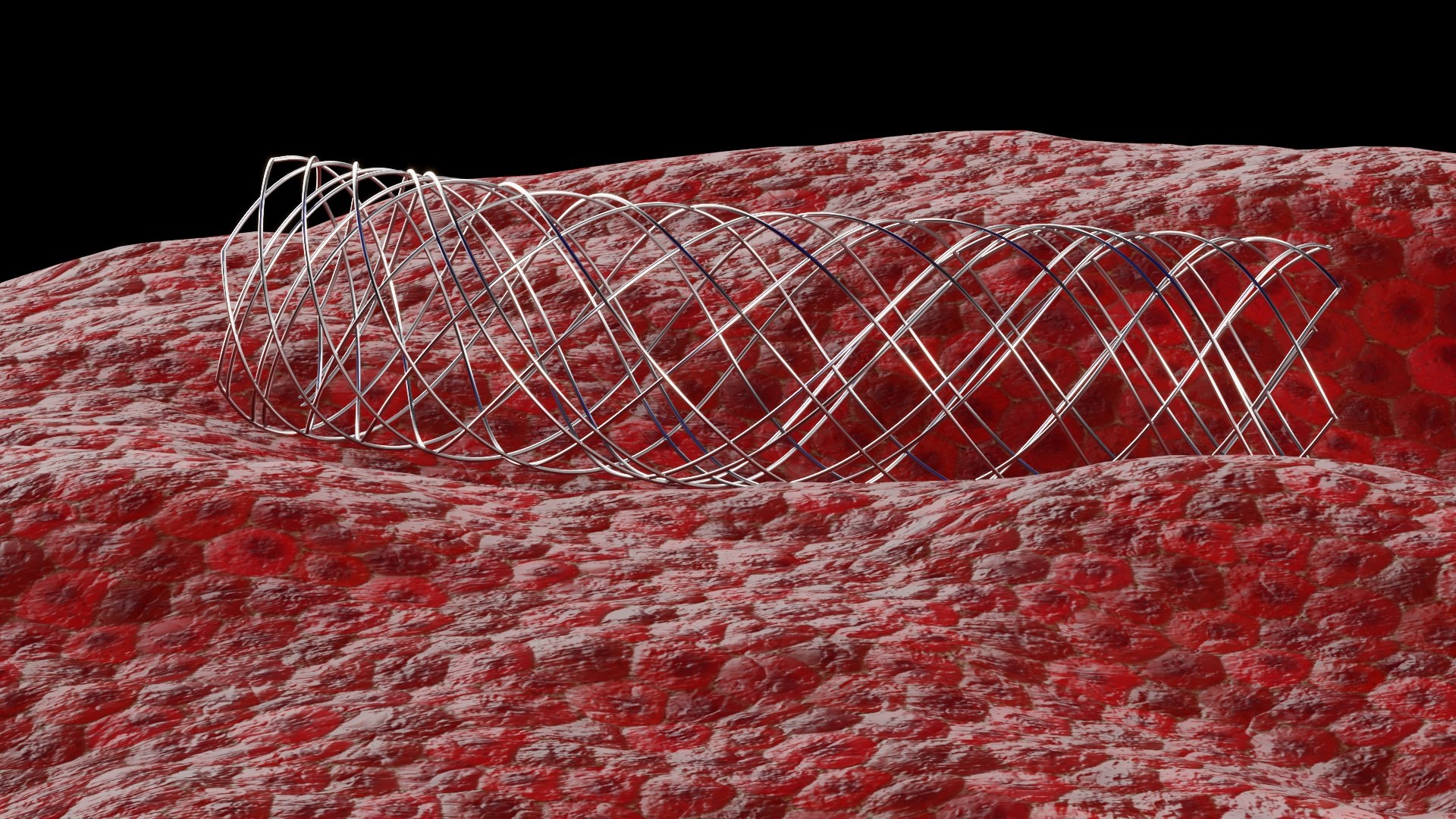 3D Model Stent Medicine Science - TurboSquid 1681496