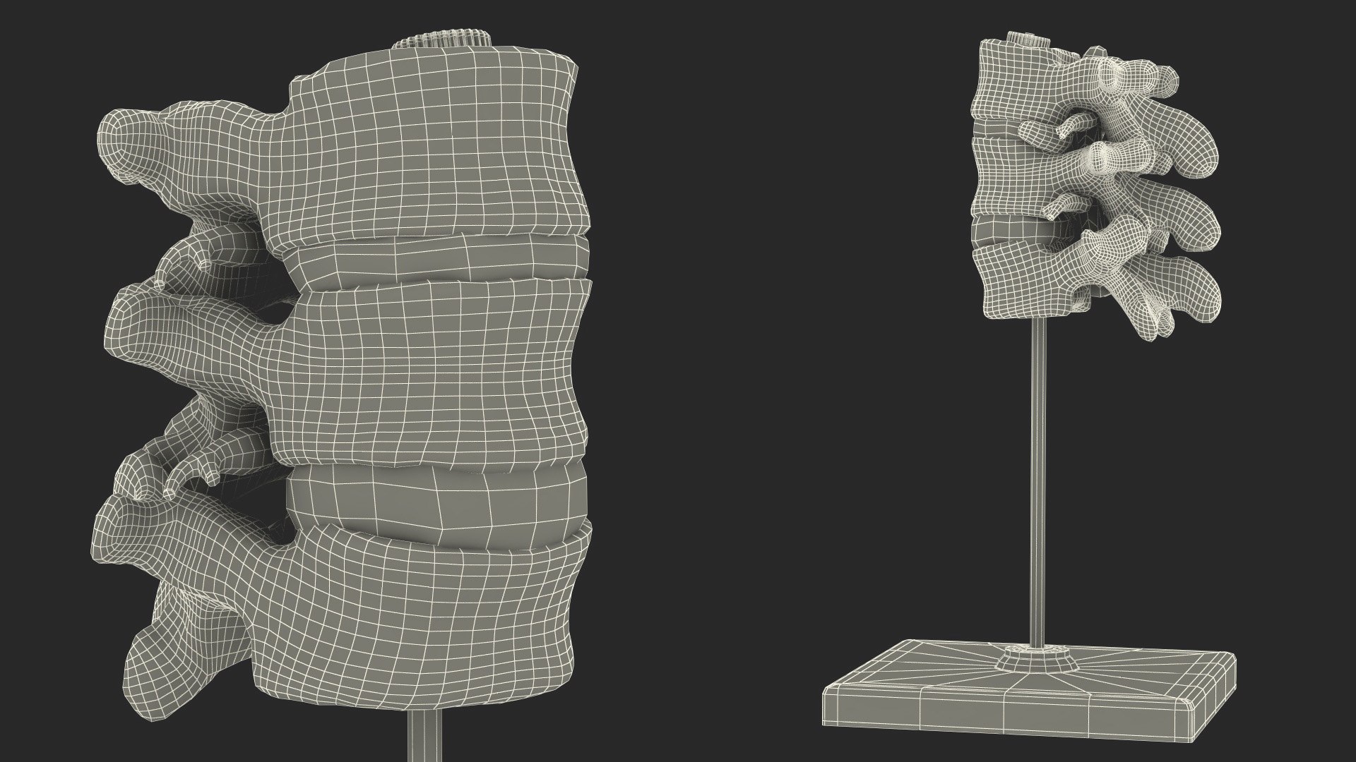 3D Herniated Vertebrae on Medical Stand model - TurboSquid 2044661