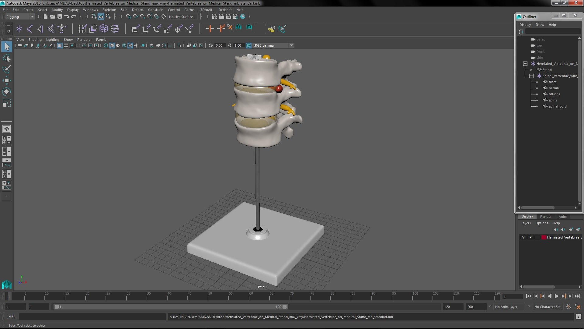 3D Herniated Vertebrae on Medical Stand model - TurboSquid 2044661