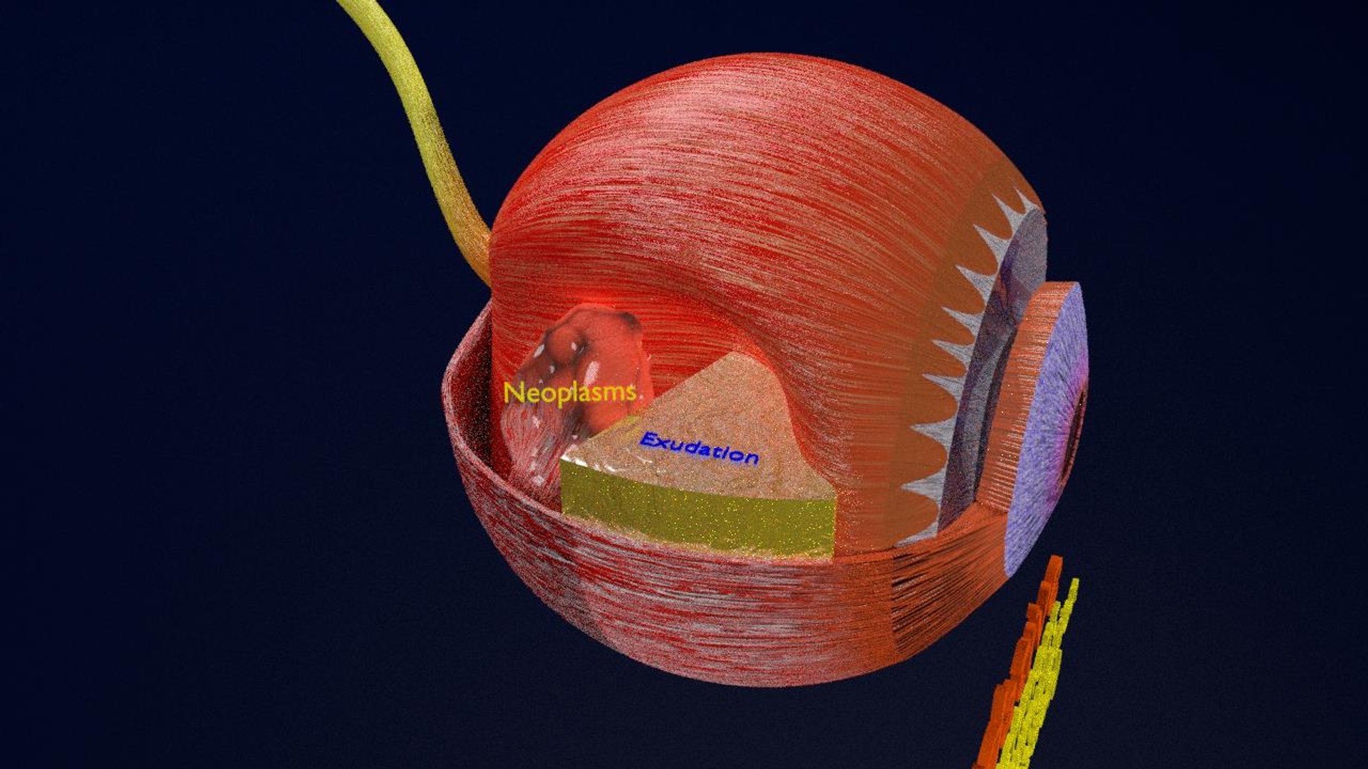 Retinal Detachment Types Eye 3D Model - TurboSquid 1774876