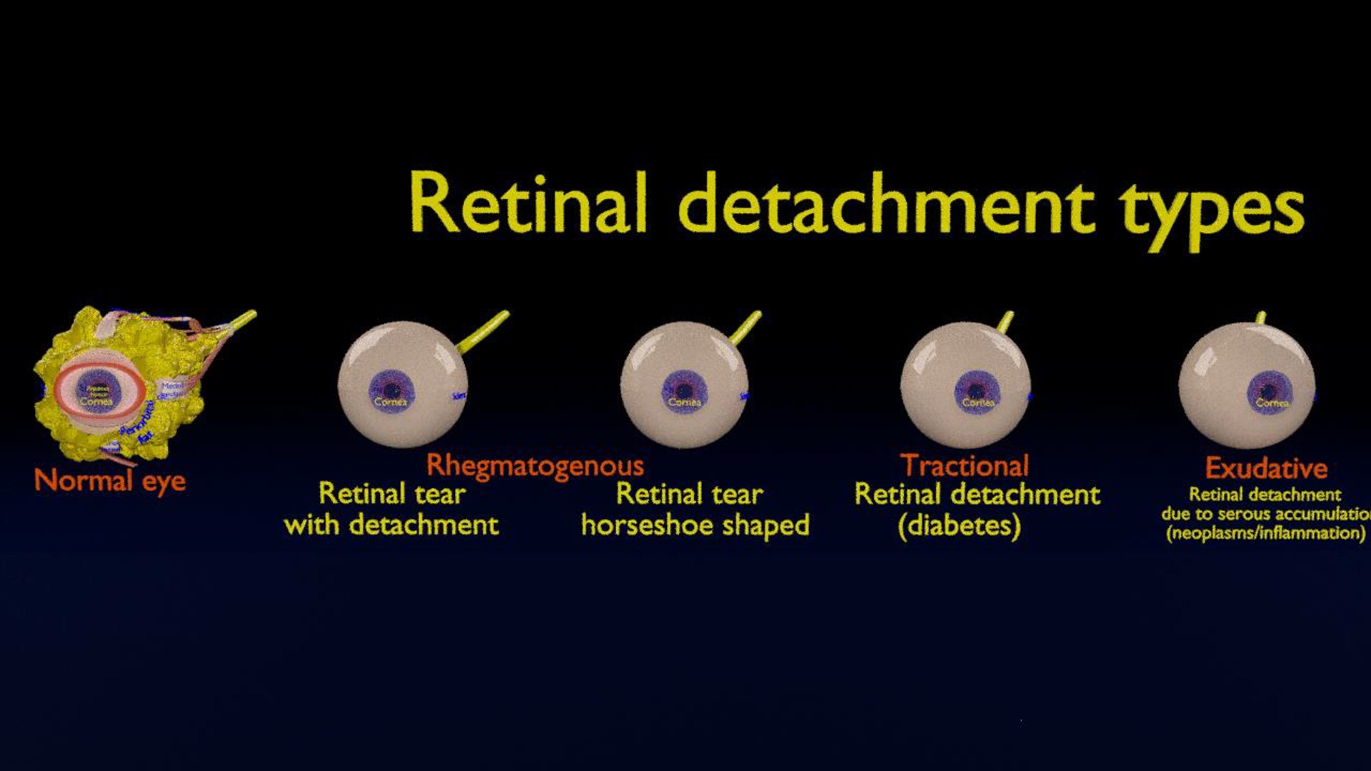 Retinal Detachment Types Eye 3D Model - TurboSquid 1774876