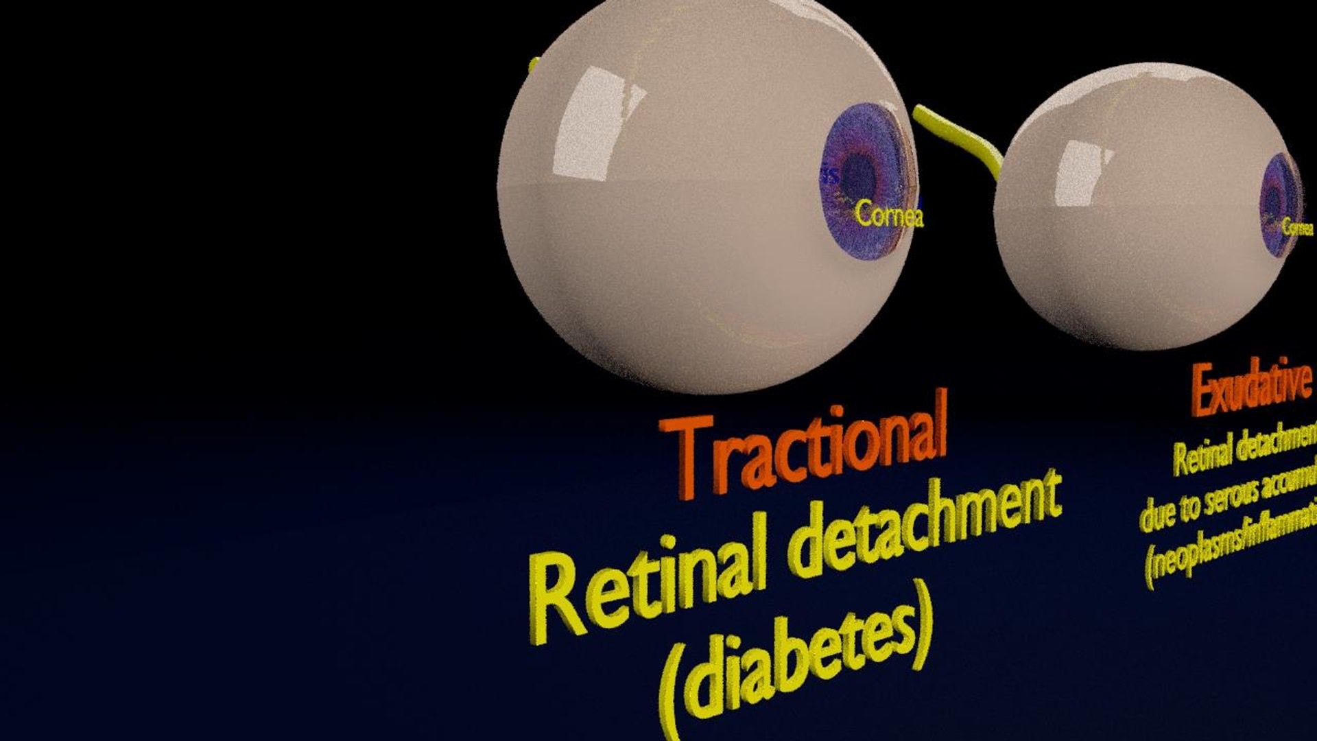 Retinal Detachment Types Eye 3D Model - TurboSquid 1774876