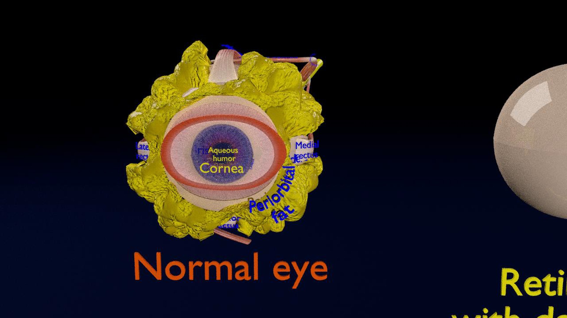 Retinal Detachment Types Eye 3D Model - TurboSquid 1774876