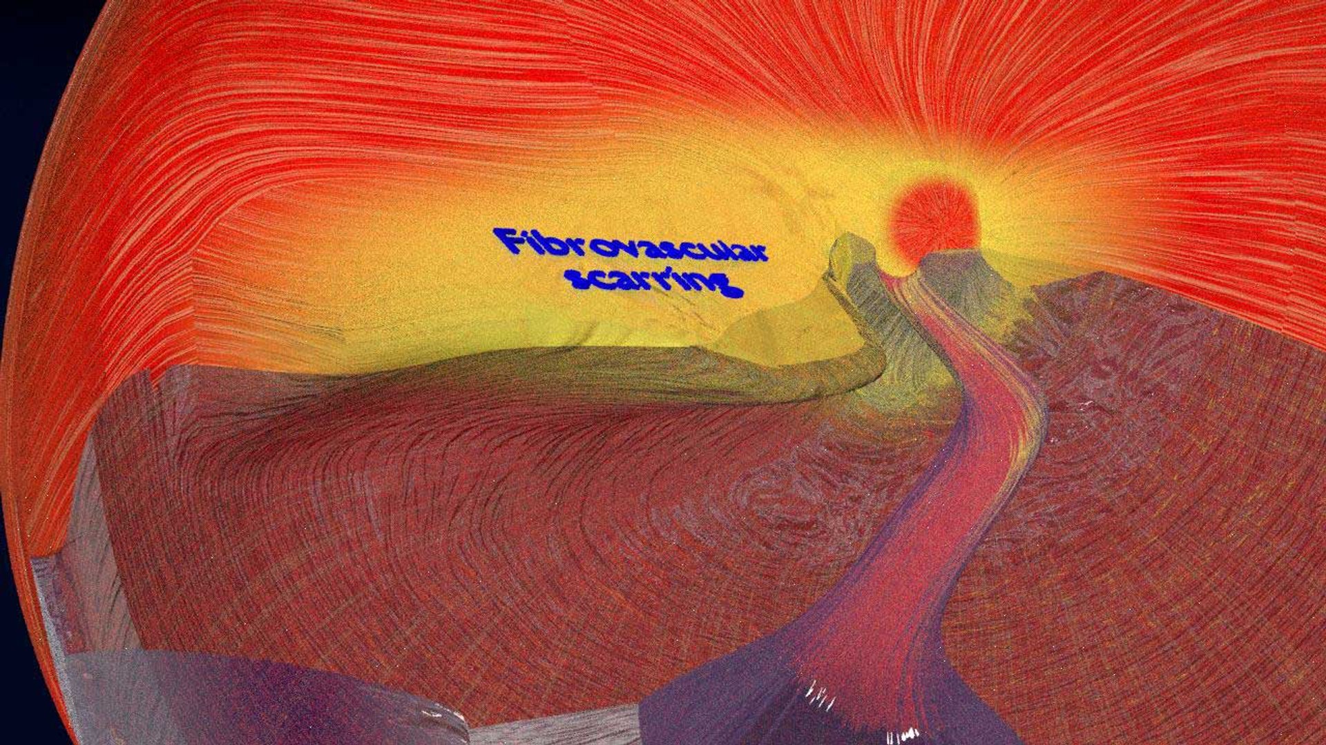 Retinal Detachment Types Eye 3D Model - TurboSquid 1774876