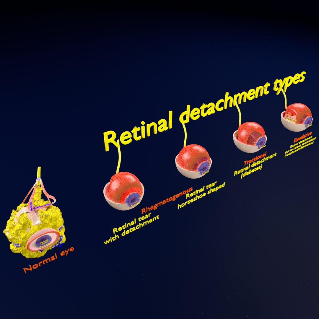 Retinal detachment types eye 3D model - TurboSquid 1774876
