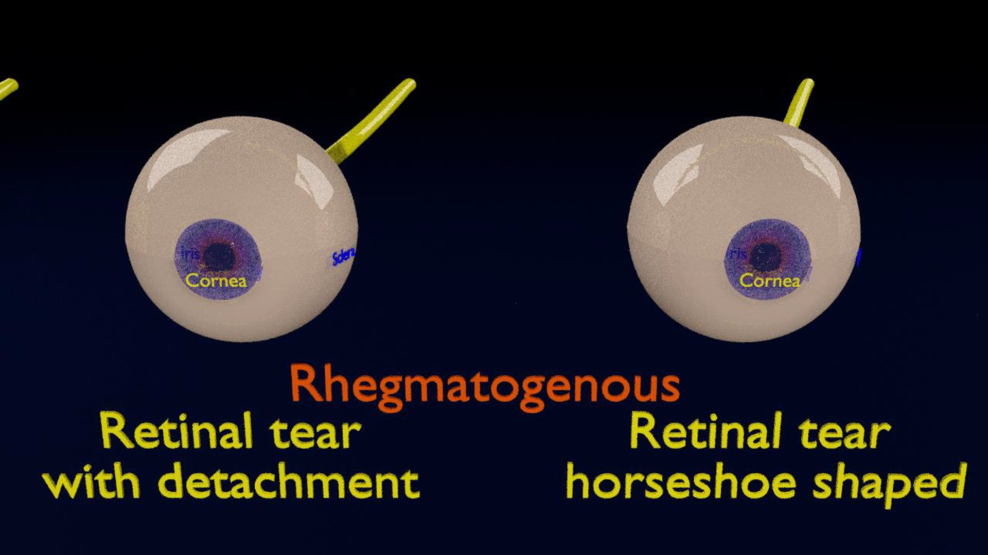 Retinal Detachment Types Eye 3D Model - TurboSquid 1774876