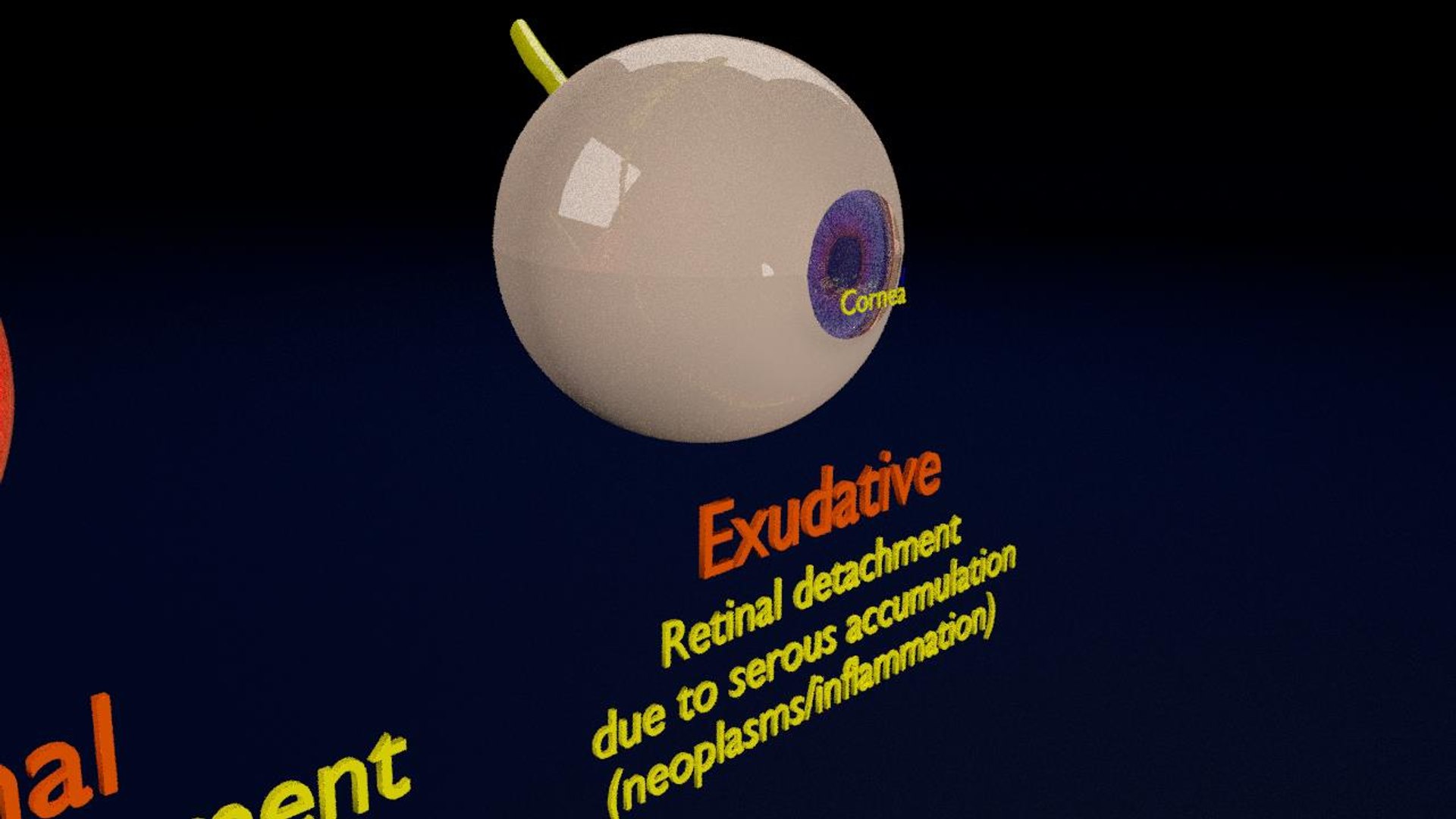 Retinal Detachment Types Eye 3D Model - TurboSquid 1774876