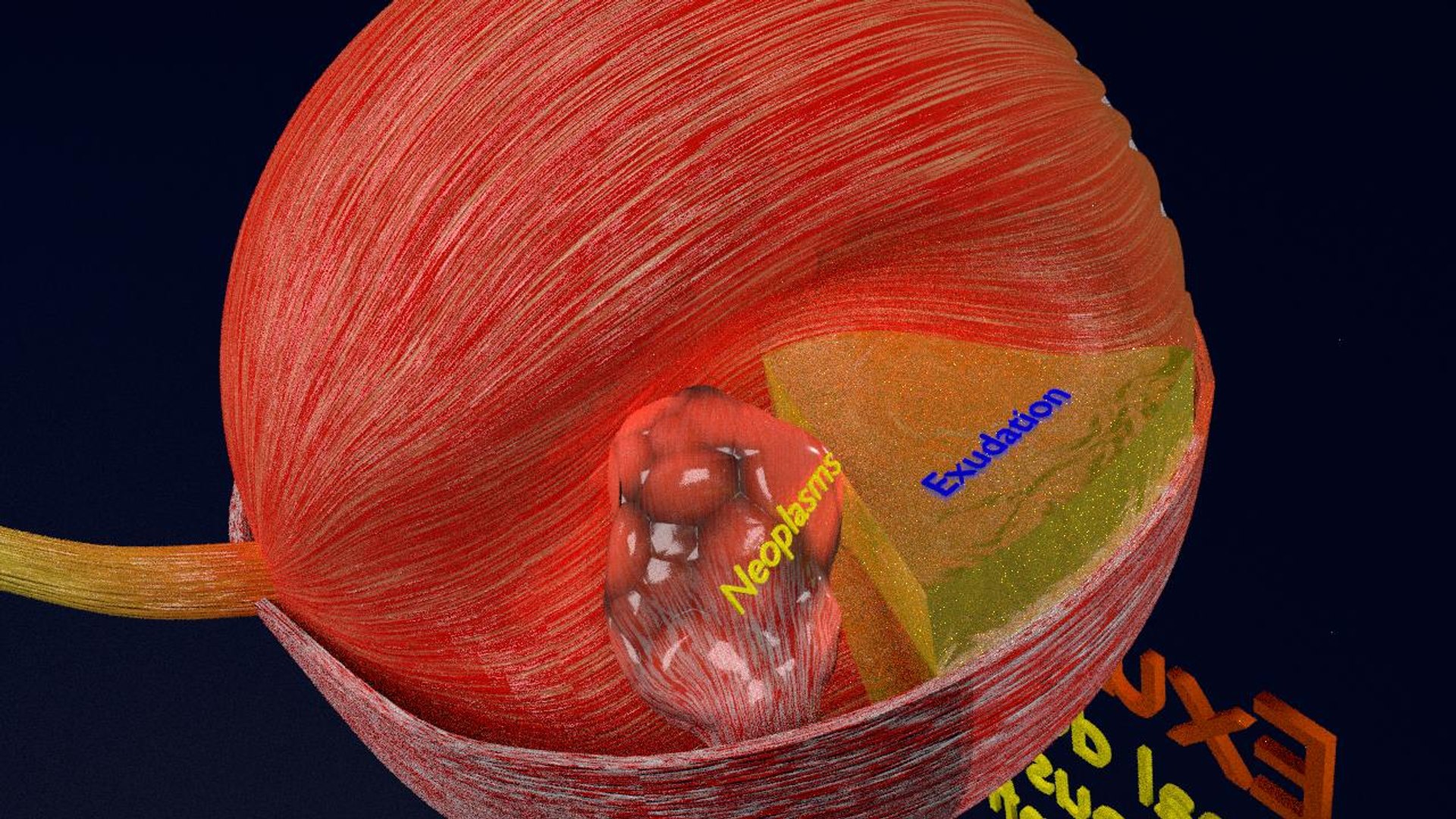 Retinal detachment types eye 3D model - TurboSquid 1774876
