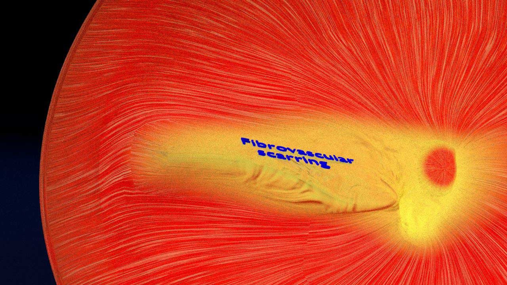 Retinal Detachment Types Eye 3D Model - TurboSquid 1774876