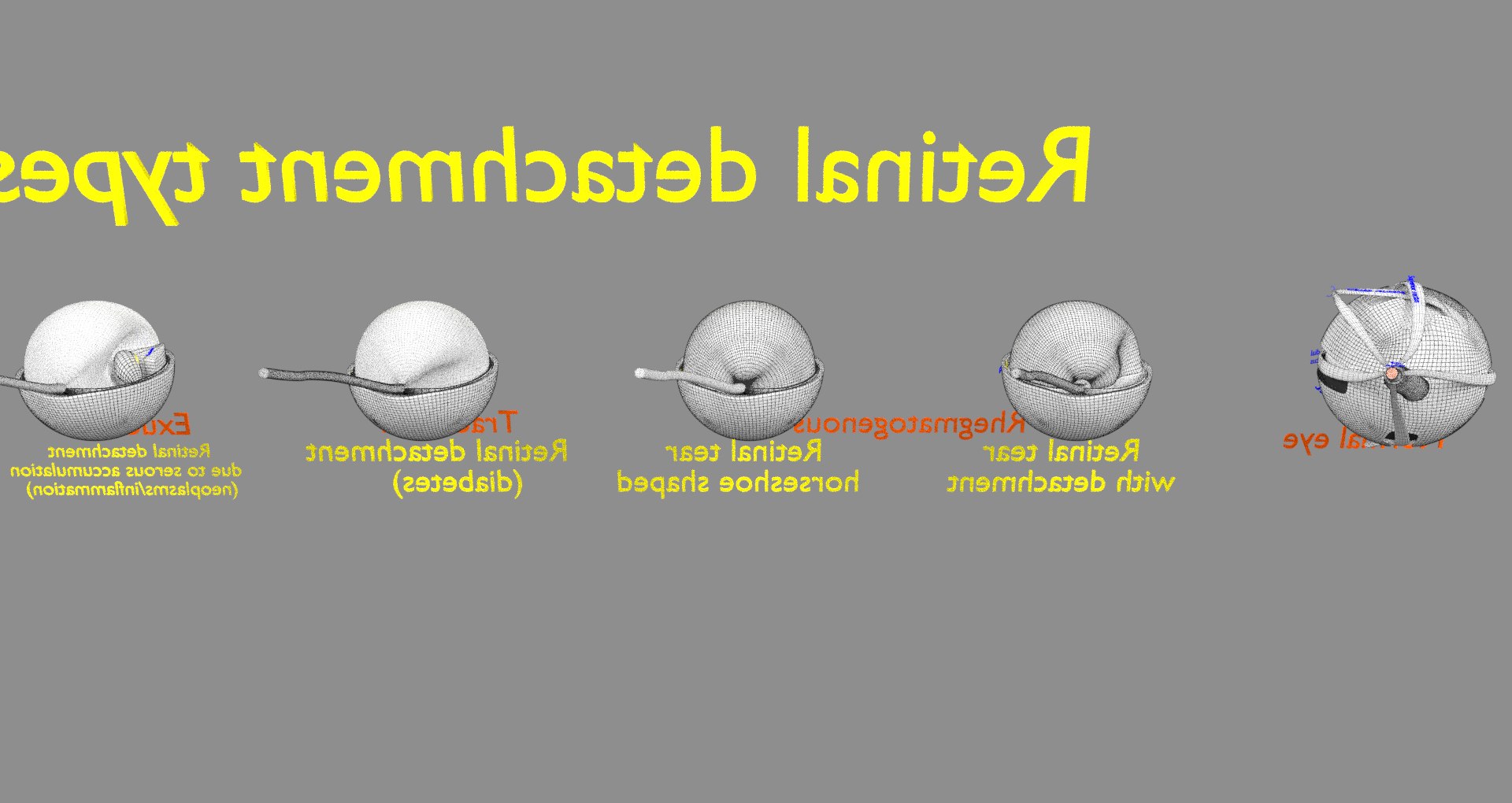 Retinal Detachment Types Eye 3D Model - TurboSquid 1774876