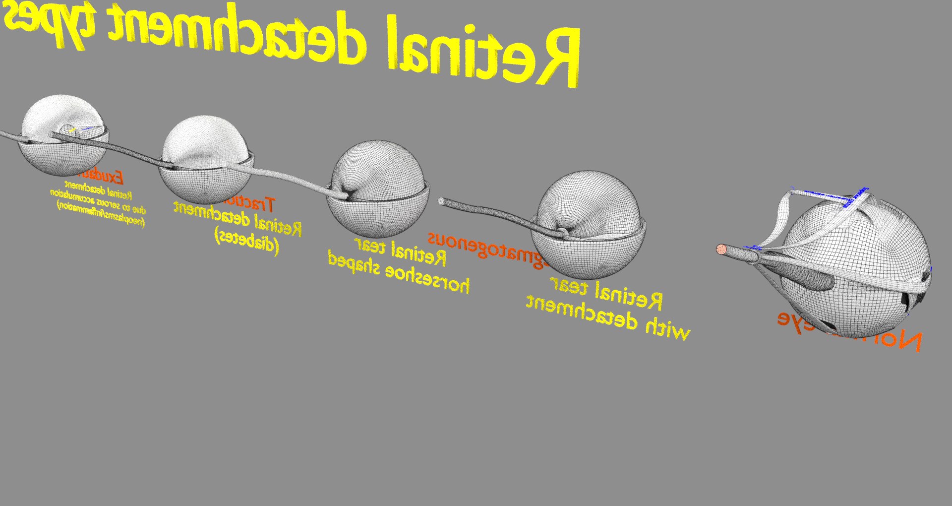 Retinal Detachment Types Eye 3D Model - TurboSquid 1774876