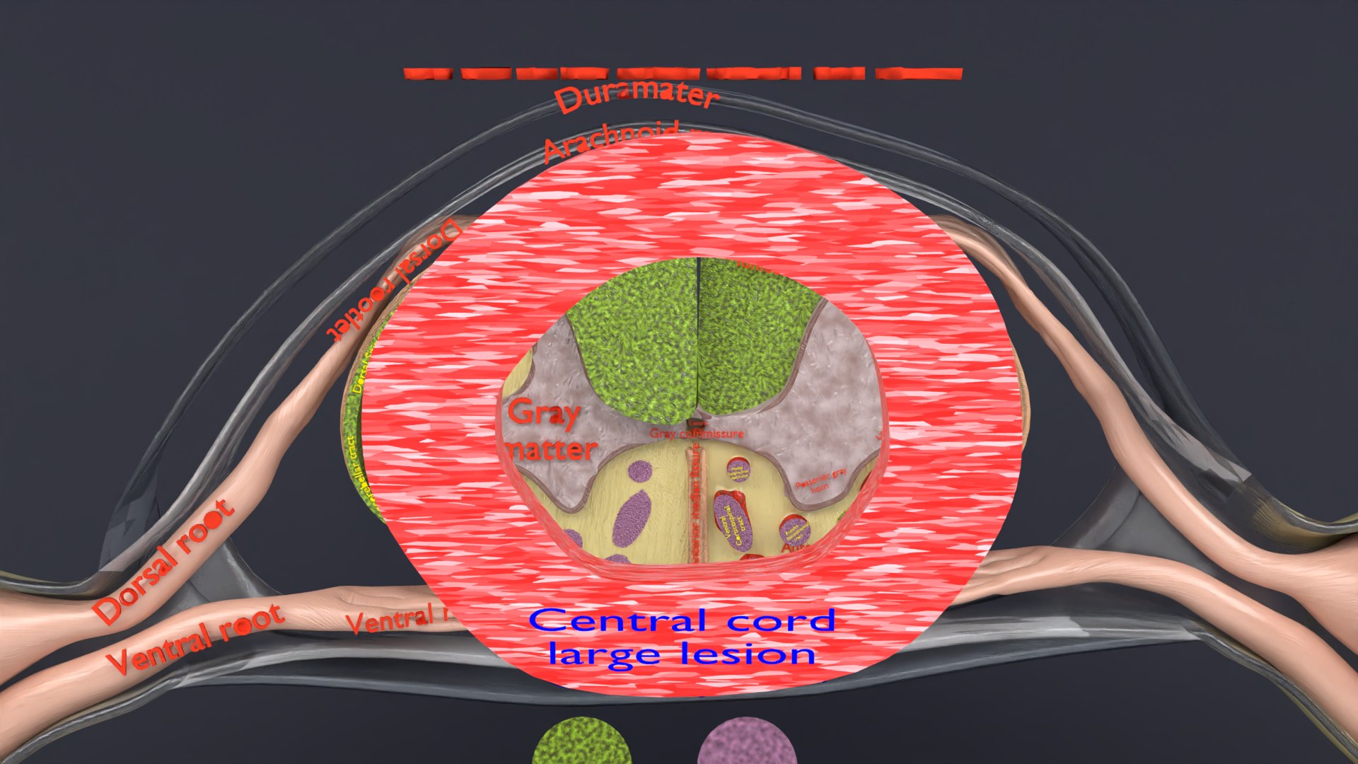 The Blend Model Depicts The Spinal Cord Injuries And Its Various ...