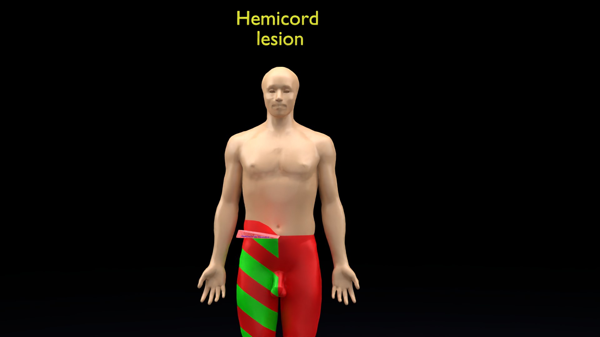 The Blend Model Depicts The Spinal Cord Injuries And Its Various ...