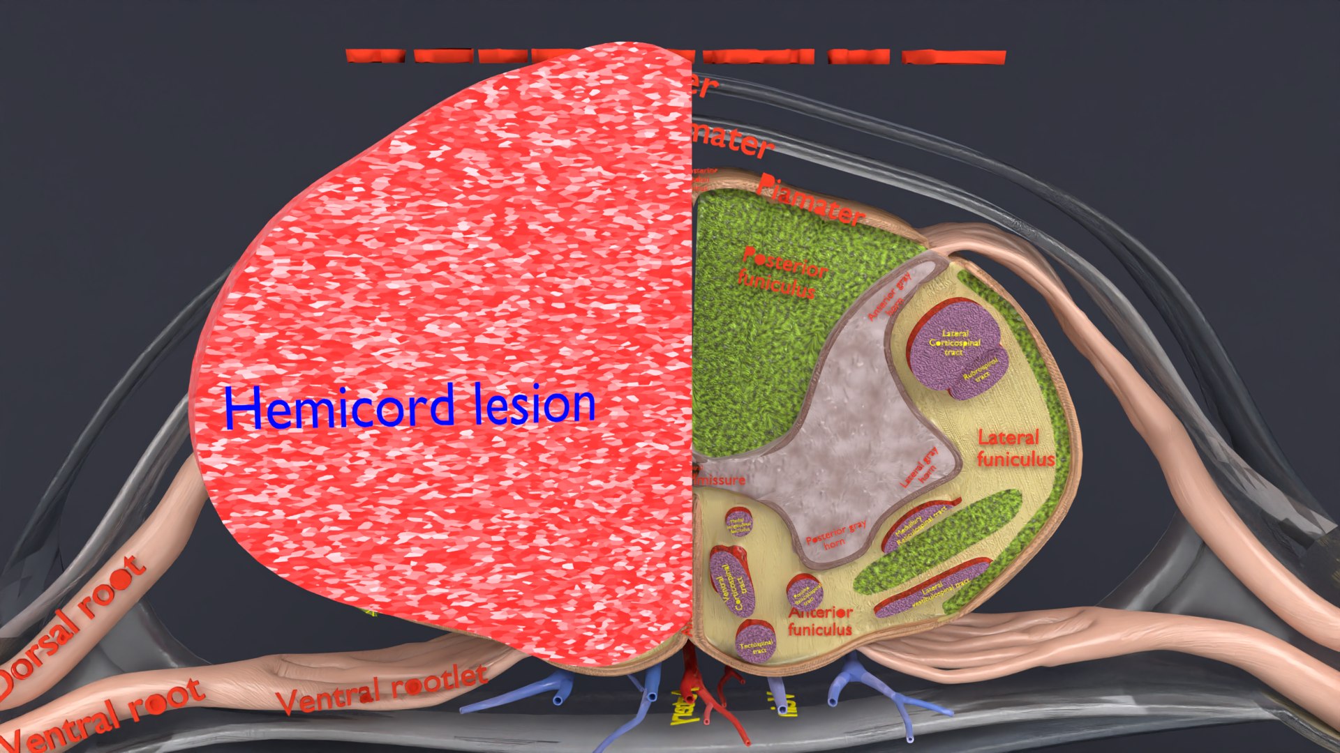 The Blend Model Depicts The Spinal Cord Injuries And Its Various ...