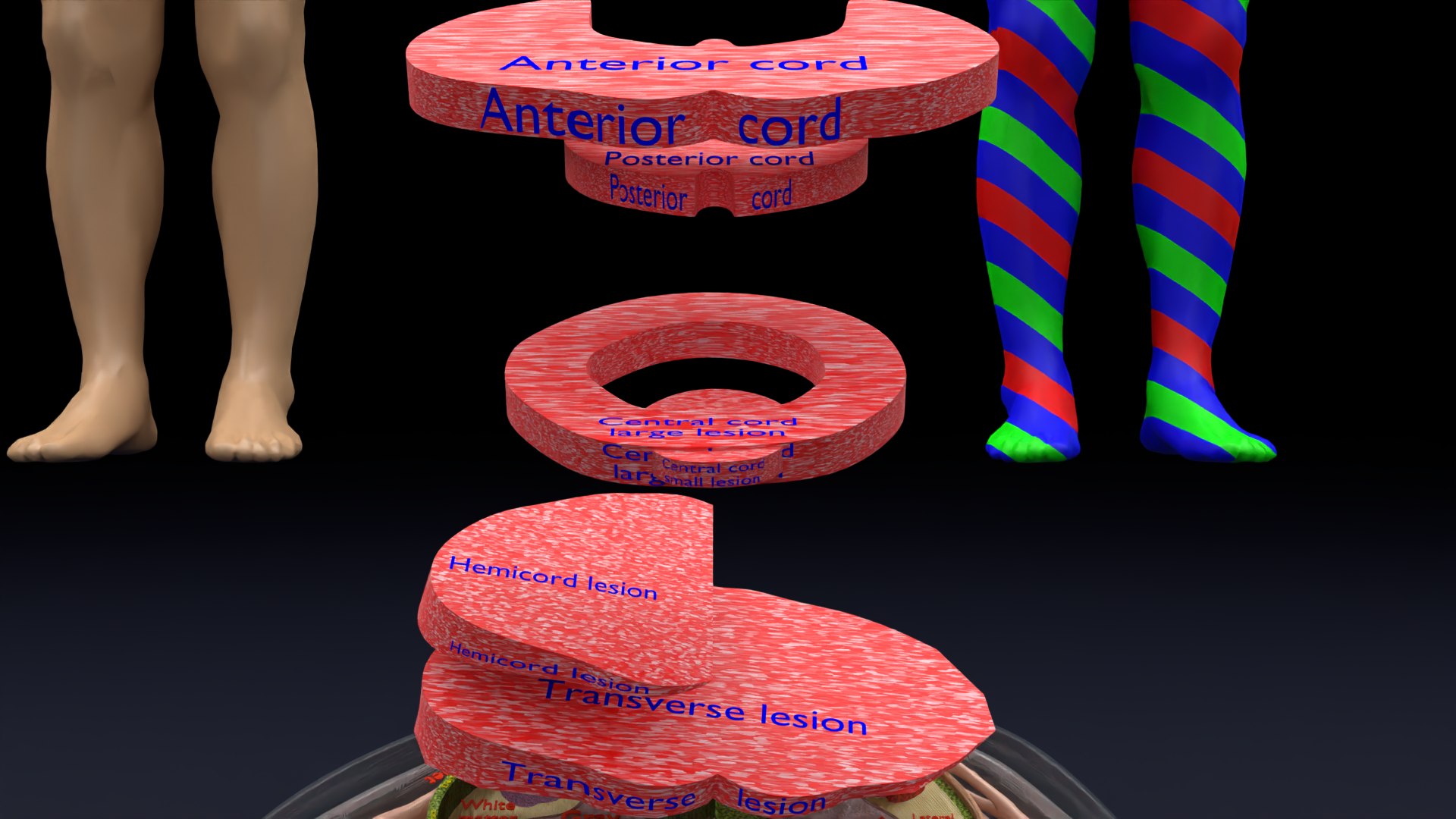 The Blend Model Depicts The Spinal Cord Injuries And Its Various ...