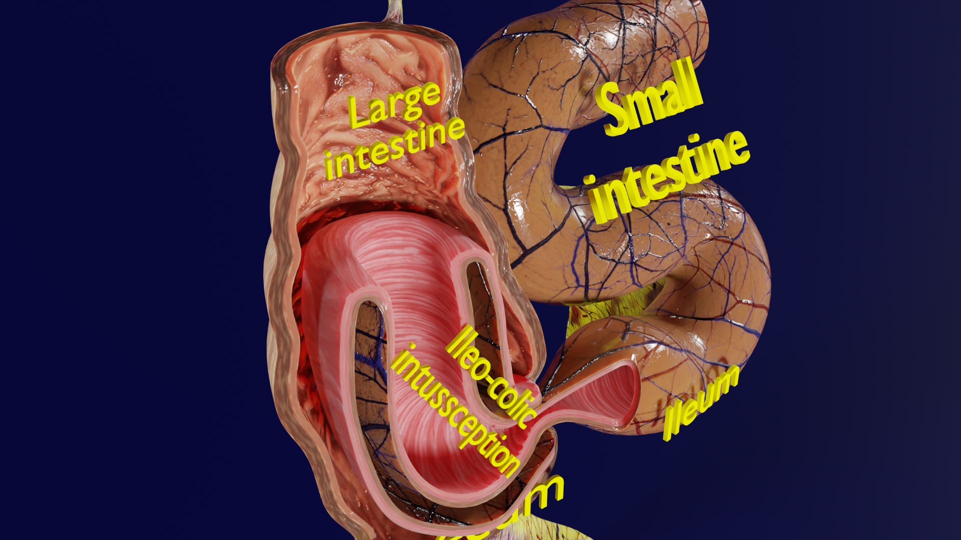 Intussusception Intestine Ileocolic Obstruction 3D - TurboSquid 2414944