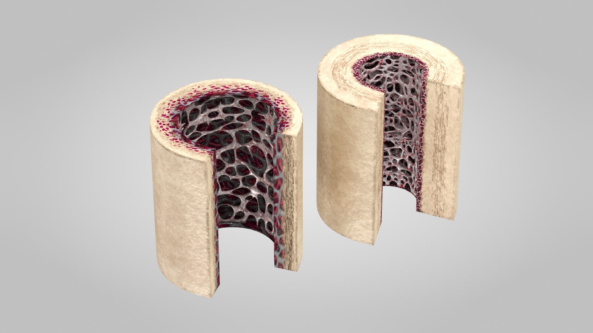 3D Healthy And Osteoporotic Bone Section - TurboSquid 1803066