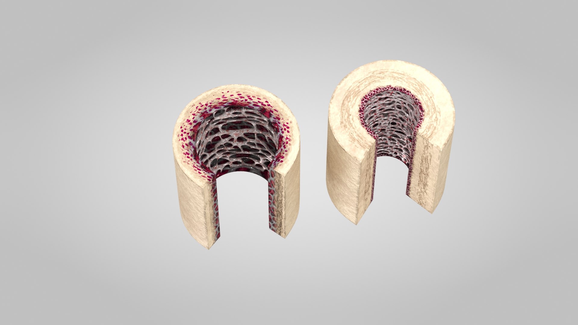 3D Healthy And Osteoporotic Bone Section - TurboSquid 1803066