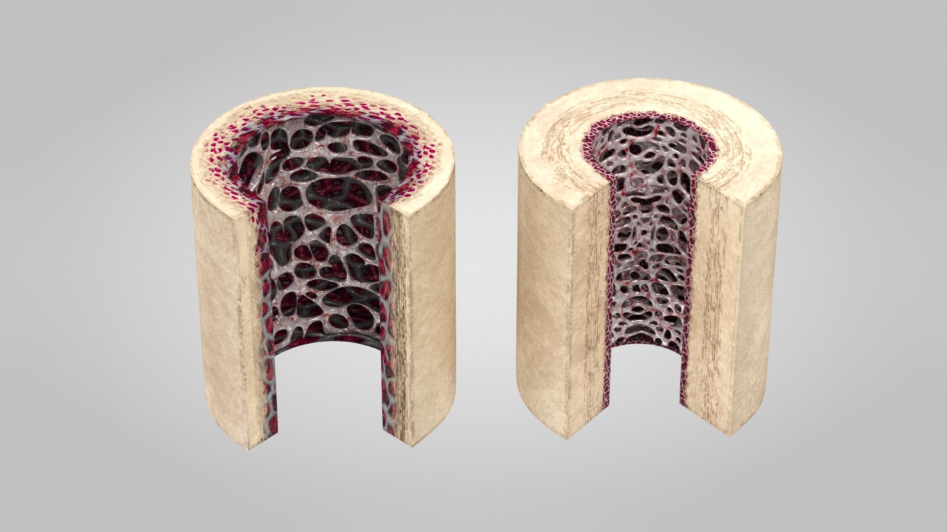3D Healthy And Osteoporotic Bone Section - TurboSquid 1803066