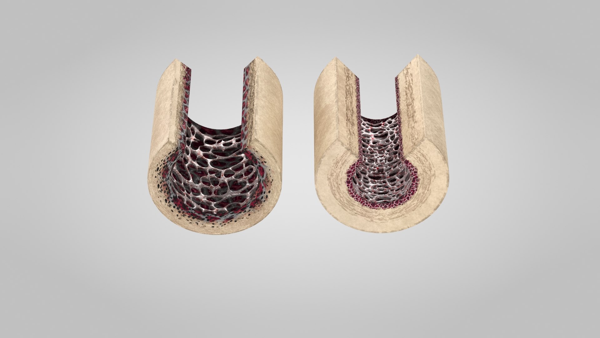 3D Healthy And Osteoporotic Bone Section - TurboSquid 1803066