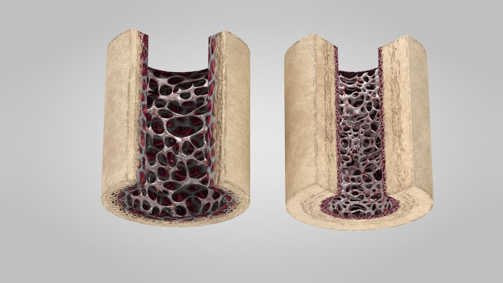 3D Healthy And Osteoporotic Bone Section - TurboSquid 1803066