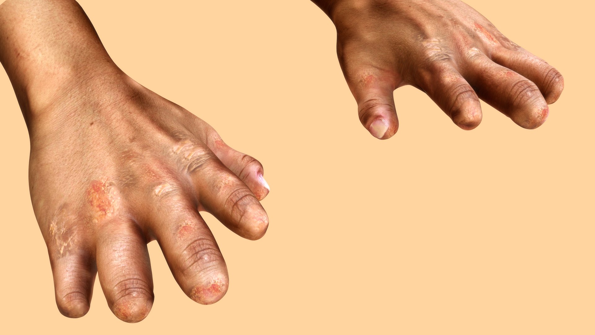 3D Leprosy Hansen Chronic Infectious Disease - TurboSquid 2184634