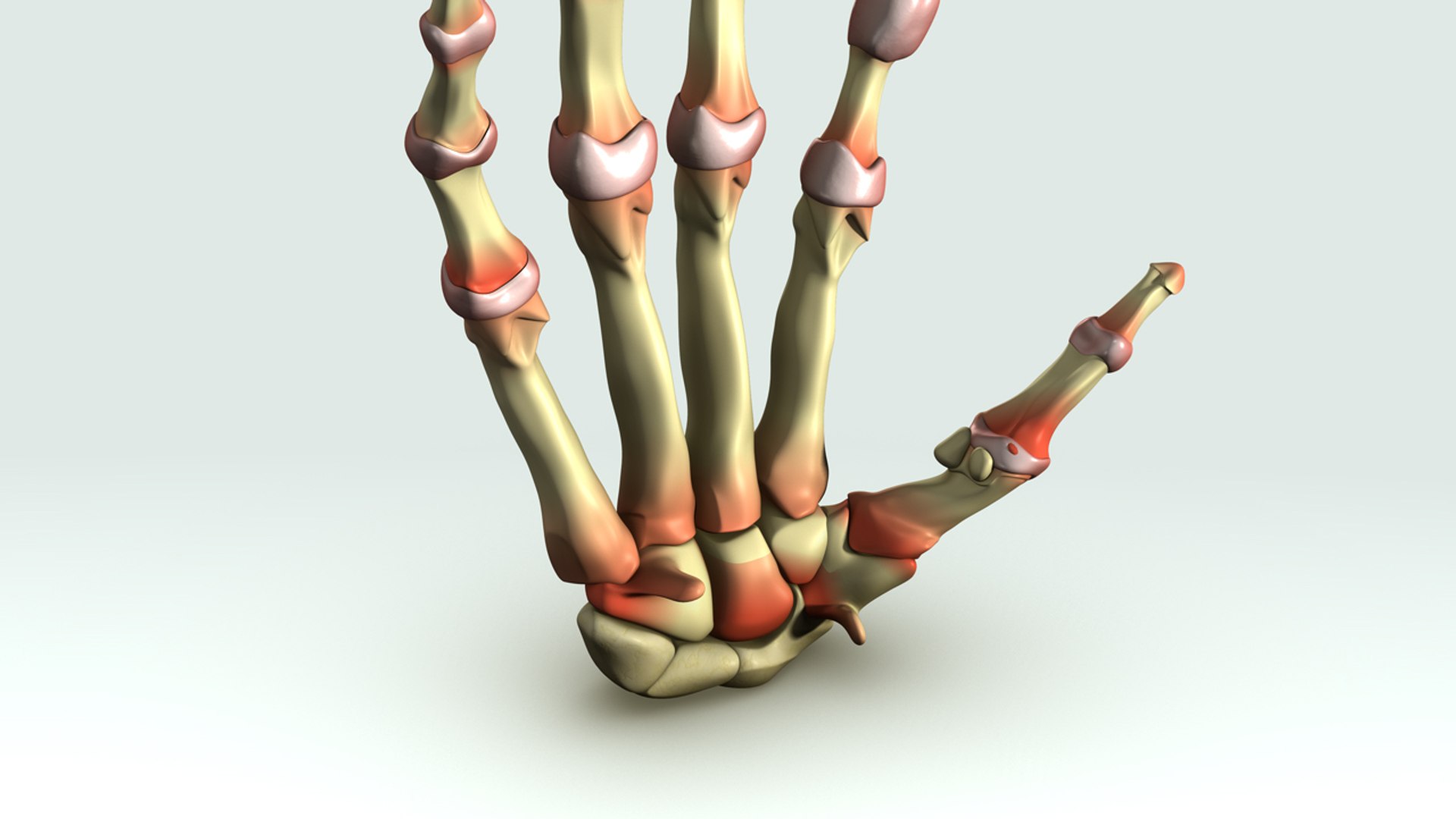 rheumatoid arthritis 3d model